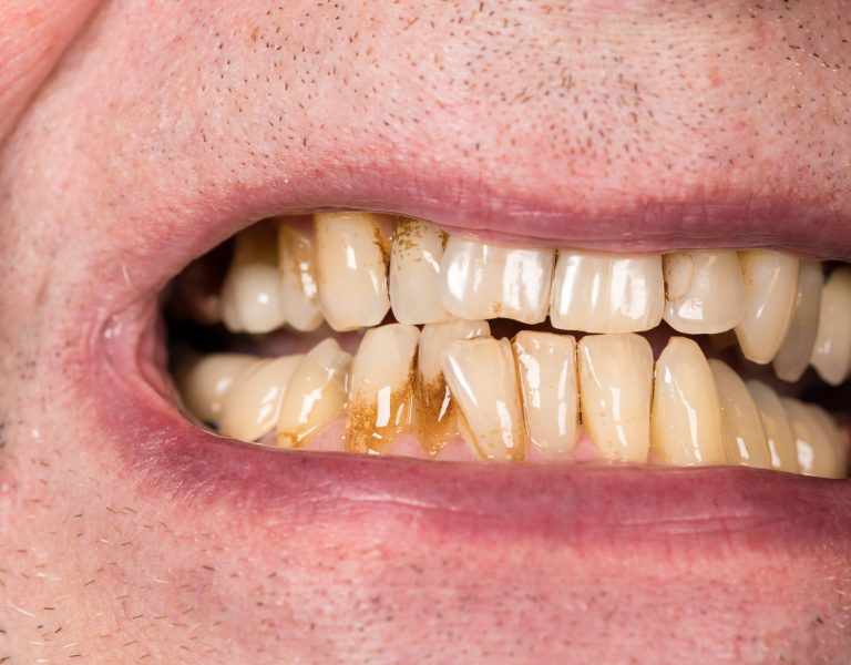 A Cosmetic Dentist Breaks Down the Causes of Teeth Discoloration